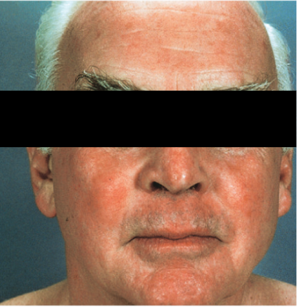 New Zealand - Efudix