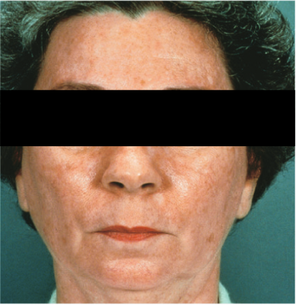 New Zealand - Efudix