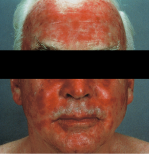 New Zealand - Efudix