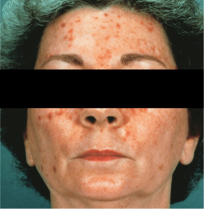 New Zealand - Efudix