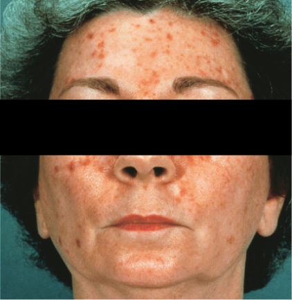 New Zealand - Efudix