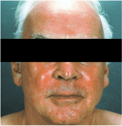 New Zealand - Efudix