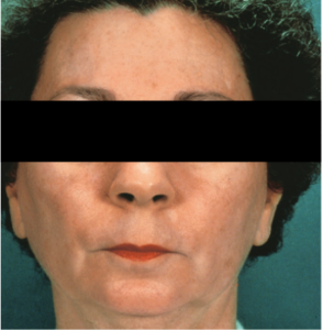 New Zealand - Efudix